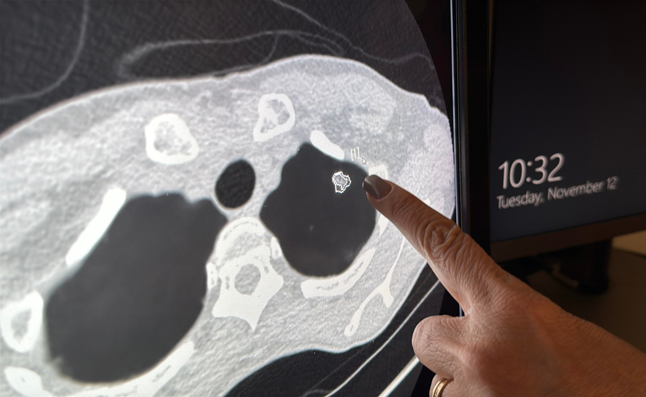AI CT Lung Cancer Screenings Drive 30% Improvement in Life-Saving Early ...