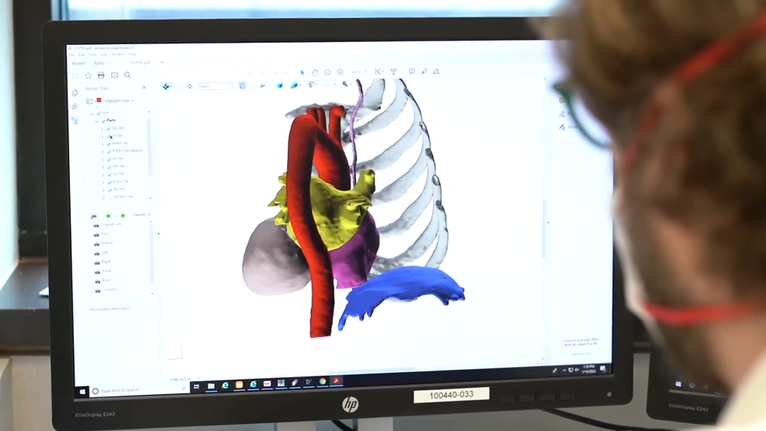 Endoscopic Heart Valve Surgery and 3D Modeling