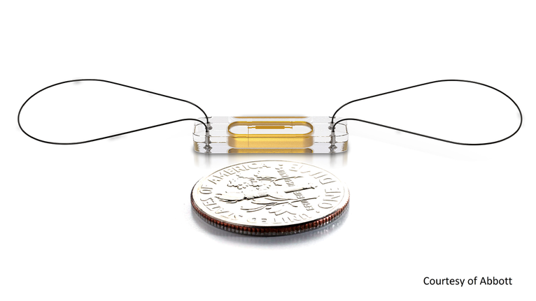 CardioMEMS: Remote Monitoring for Heart Failure Patients