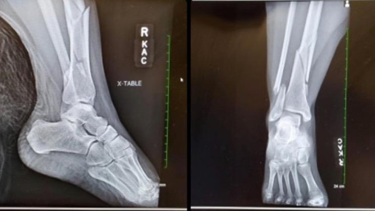 Ankle Surgeon Fixes Mother's Complex Injury