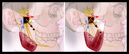 Facial Paralysis | Facial Plastic & Reconstructive Surgery | UC Health