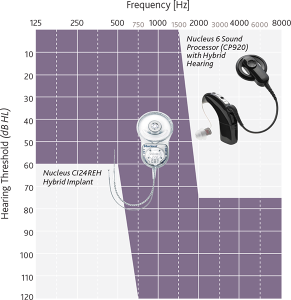 ENT Insights | Hybrid Cochlear Implant Fills the Gap between Partial ...