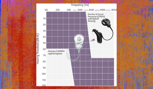 ENT Insights | Hybrid Cochlear Implant Fills the Gap between Partial ...