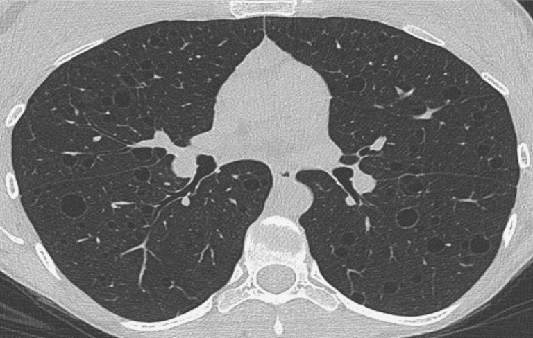 Pulmonary Insights | HRCT image 1