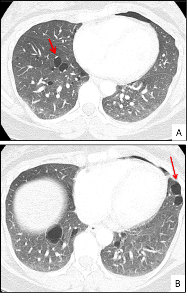 Pulmonary Insights | HRCT is Cost-Effective in Screening for Diffuse ...